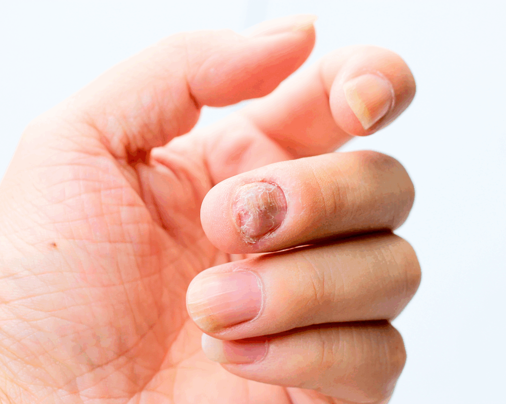 Doenças das Unhas: Como Identificar Sinais de Alerta para Problemas ...