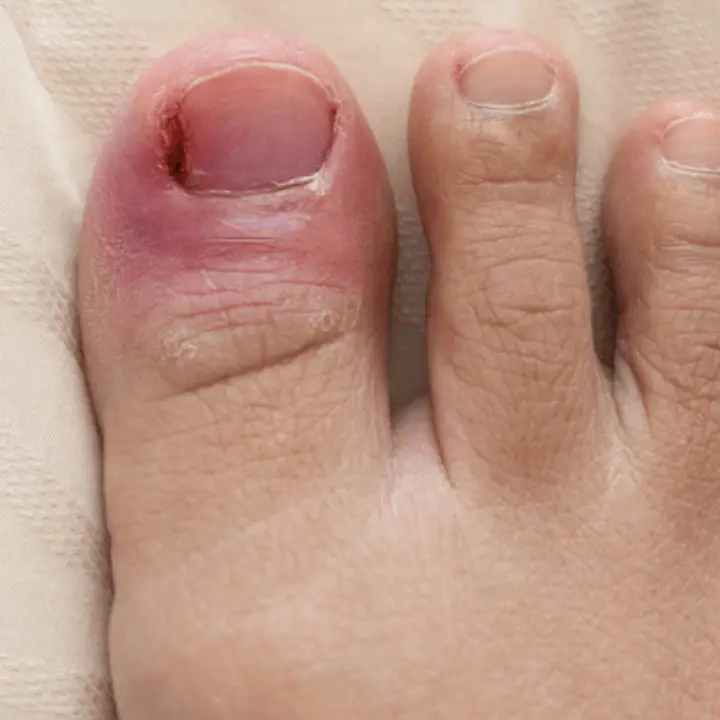 Doenças de Unhas: Entenda os Sintomas, Causas e Tratamentos - Tatiana ...